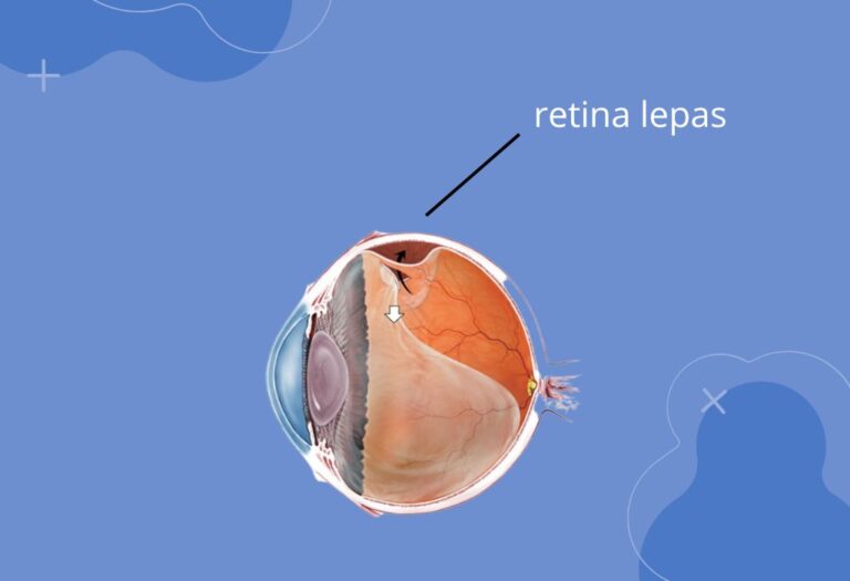 5+ Penyebab Ablasio Retina, Faktor Kebutaan Tanpa Sakit