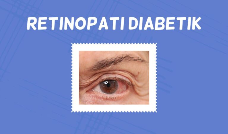 Retinopati Diabetik: 2+ Kondisi Diabetes Pada Mata