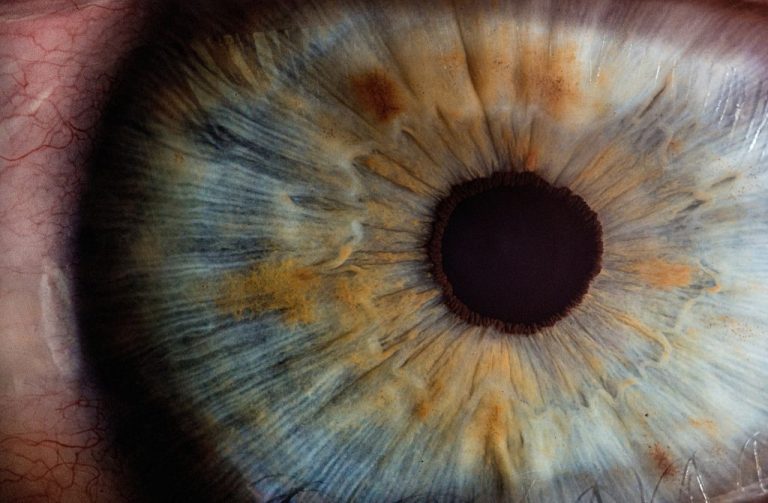 Iris Mata Bikin Mata Jadi Cantik, Ini 8 Penyakit Pada Iris